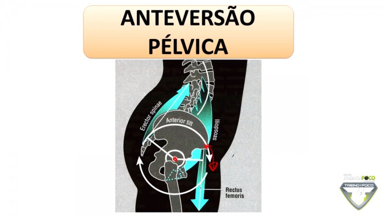 Como utilizar a biofotogrametria para avaliar a anteversão pélvica?