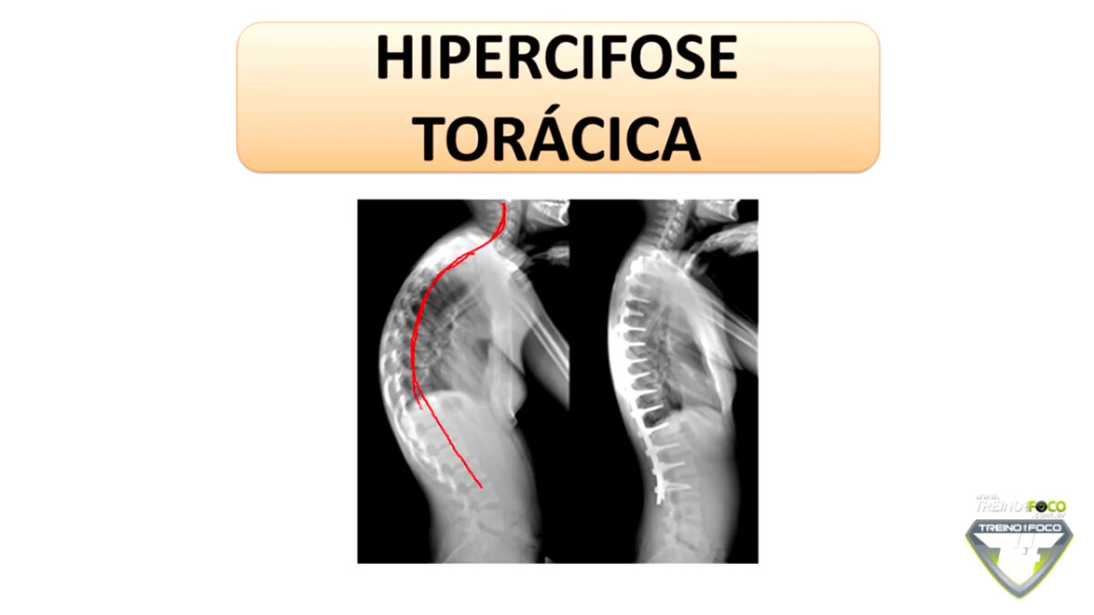 Como quantificar a hipercifose torácica através da biofotogrametria?