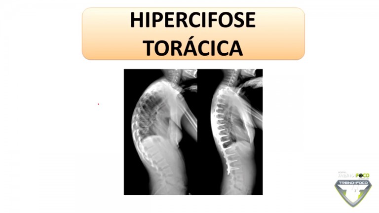 Como quantificar a hipercifose torácica através da biofotogrametria?