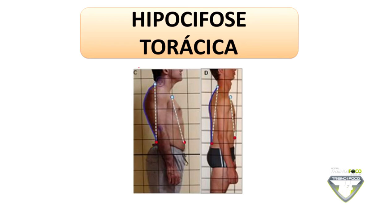 Como avaliar hipocifose torácica através da biofotogrametria?